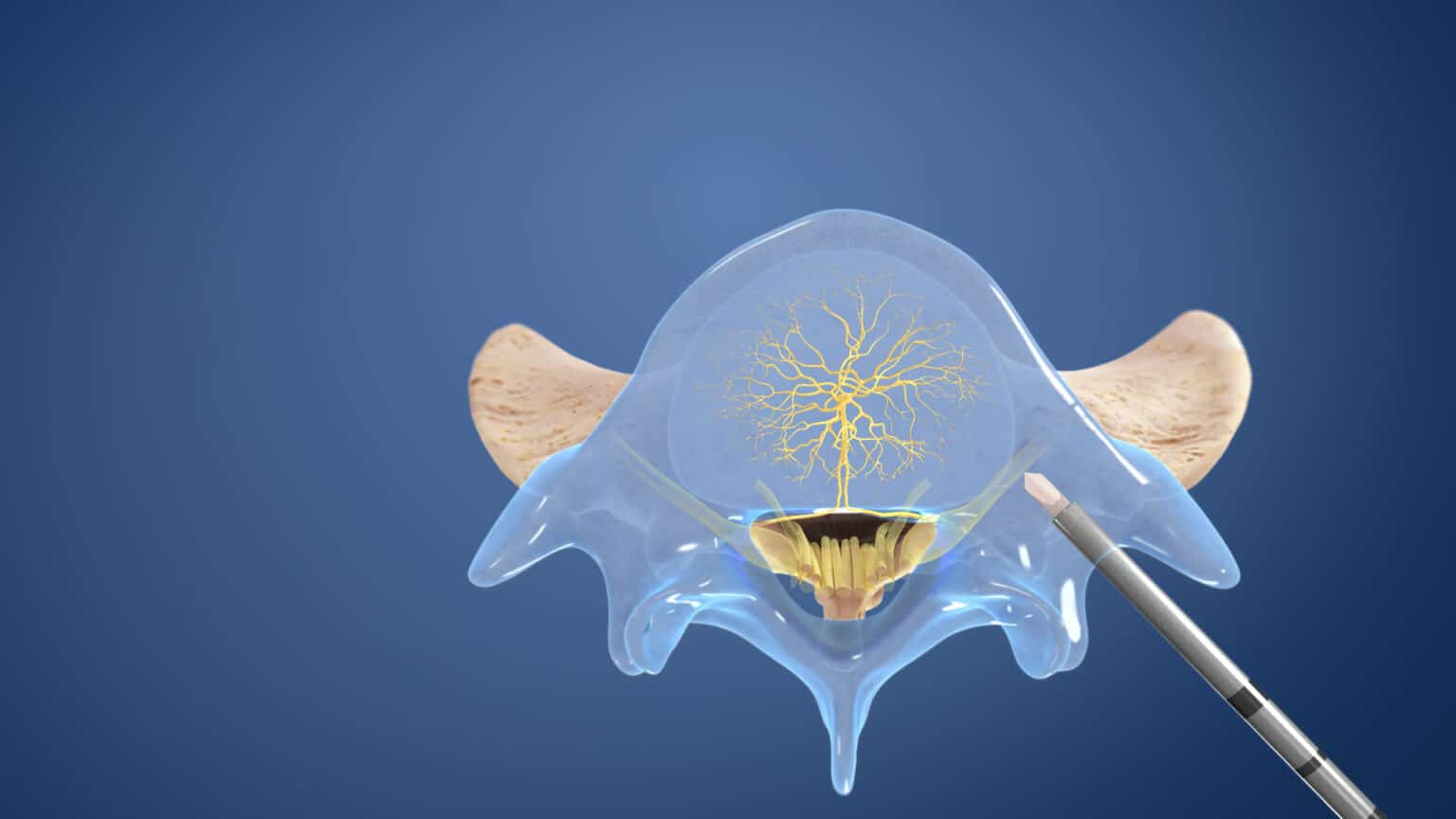 Intracept Procedure - The Southeastern Spine Institute