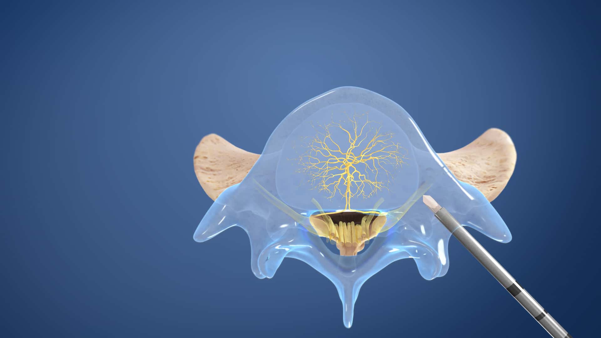 Intracept Procedure - The Southeastern Spine Institute