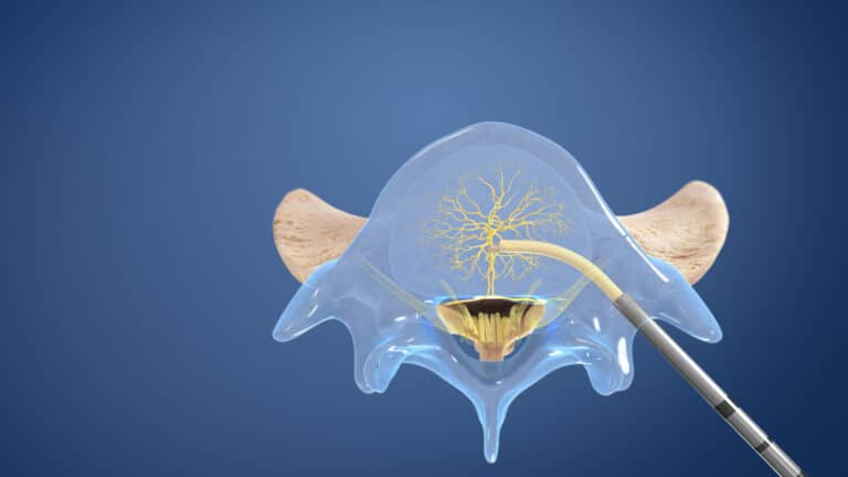 Intracept Procedure - The Southeastern Spine Institute
