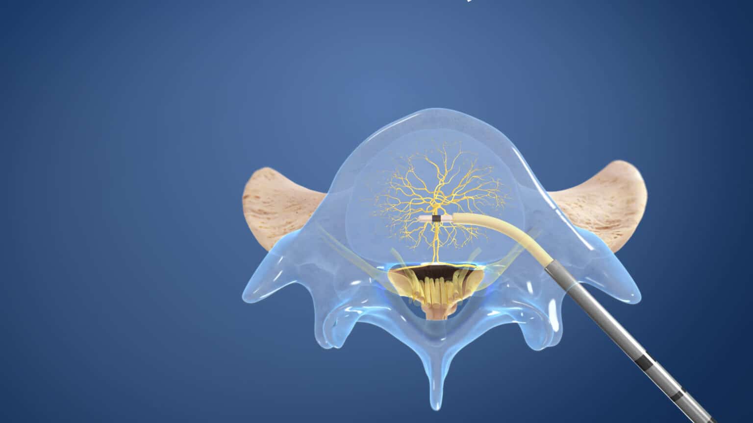 Intracept Procedure - The Southeastern Spine Institute