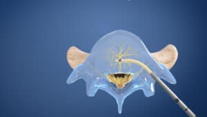 Intracept Procedure - The Southeastern Spine Institute