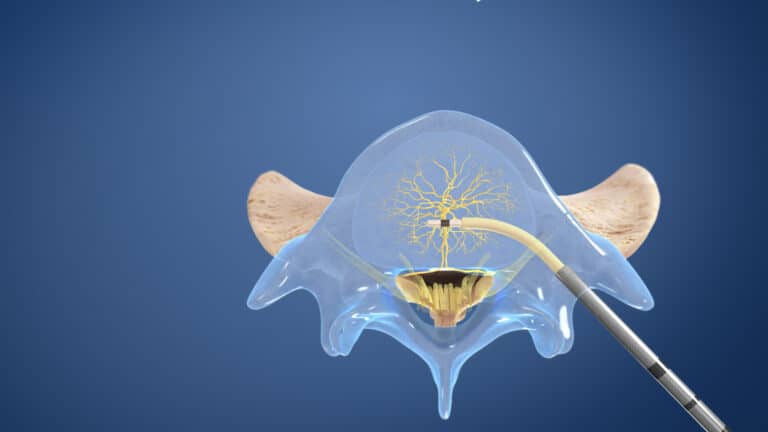 Intracept Procedure - The Southeastern Spine Institute