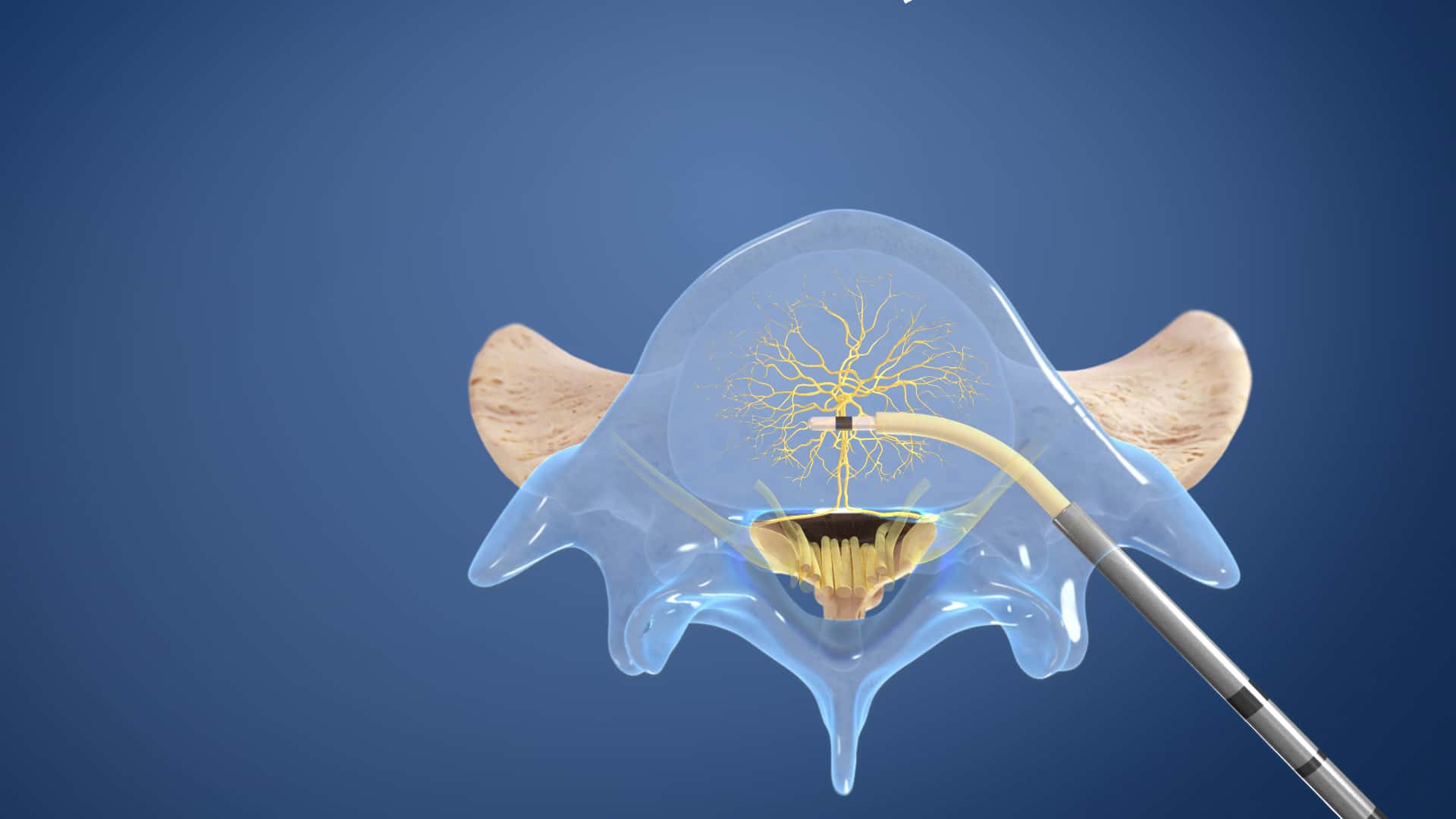 Intracept Procedure - The Southeastern Spine Institute